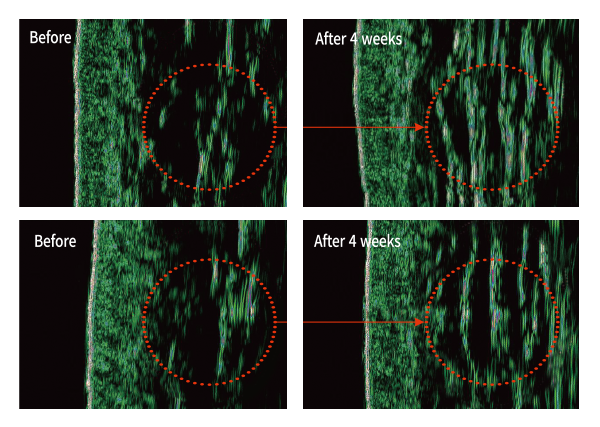 Plason 超氣態電漿肌膚管理系統 - Collamatrix 膠原科技